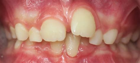 Quand Consulter Un Orthodontiste B Atrice Chican Minier