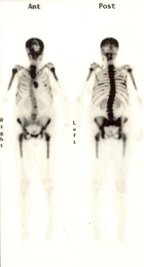 Bone Scan With Tc 99m MDP Showing Multiple Foci Of Increased Isotope