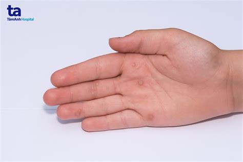 Mụn cóc phẳng Nguyên nhân dấu hiệu nhận biết và cách phòng ngừa
