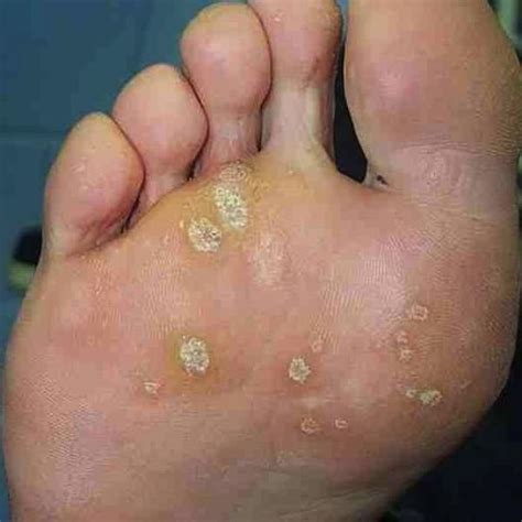 Cómo quitar una verruga plantar cuál es el mejor tratamiento