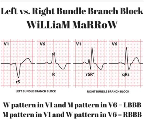 Left Bundle Branch Block Ecg