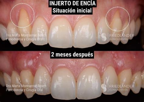 Evolución de un injerto de encía y sus diferentes etapas