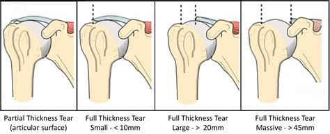 Rotator Cuff Disease Cambridge Shoulder