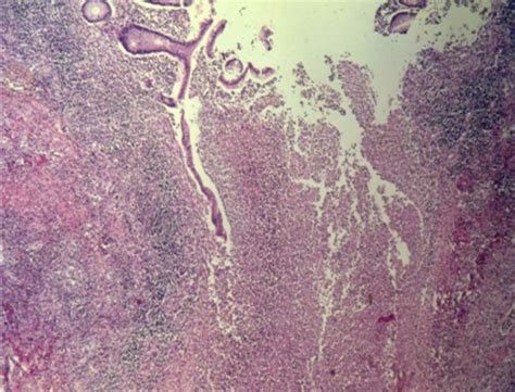 Fichas de aprendizaje Img Inflamación Aguda Crónica y Granulomatosis
