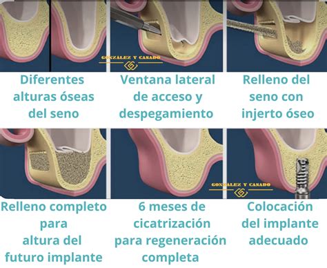 Elevación de seno maxilar para Implantología González y Casado