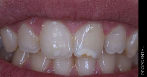 Qué es la hipoplasia dental Tratamiento de la hipoplasia del esmalte