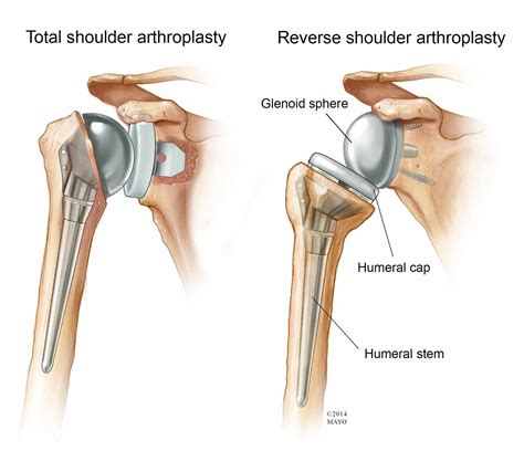 Tuesday Q And A Reverse Shoulder Arthroplasty May Be Best Option For