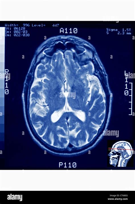 Irm Normal Du Cerveau Banque De Photographies Et Dimages Haute