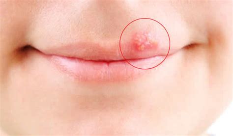 Herpes labial o que é porque surgem e como tratar Já é notícia