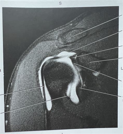 Coronal Oblique T Shoulder Diagram Quizlet