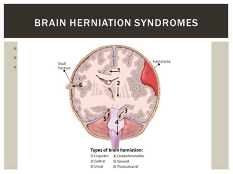 Adult Health 2 Acute Intracranial Problems Flashcards Quizlet