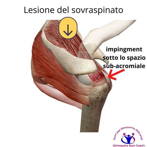 Topo O Ratto Teoria Affermata Grafia Lesione Del Tendine Della Spalla