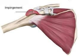 How Long Does It Take To Recover From Arthroscopic Shoulder