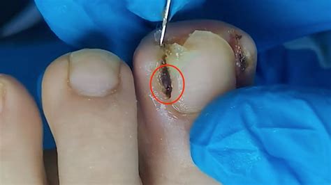 Daily Pedicure TutorialRemoving Deeply Embedded Ingrown Toenails On