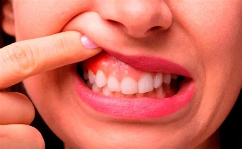 Qué es una fístula dental y cómo se trata Chapin TV