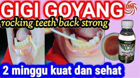 Cara Mengatasi Gigi Goyang Kembali Kokoh Kuat Youtube