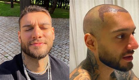 6 Famosos Que Fizeram Transplante Capilar Veja Resultado DCI