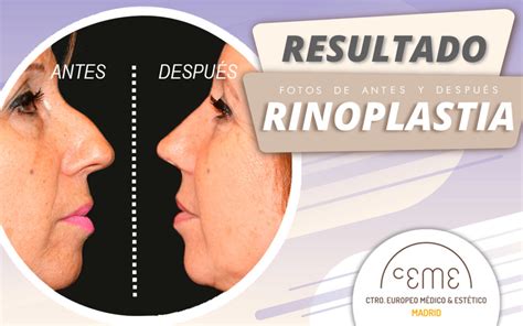 Frenuloplastia