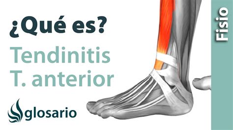 Tendinitis Qué Es Cuáles Son Sus Causas Y Cómo Es 51 OFF