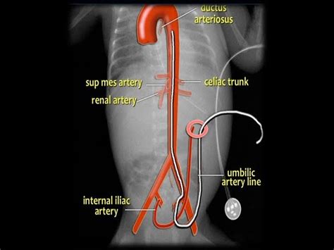 Umbilical Artery Anatomy