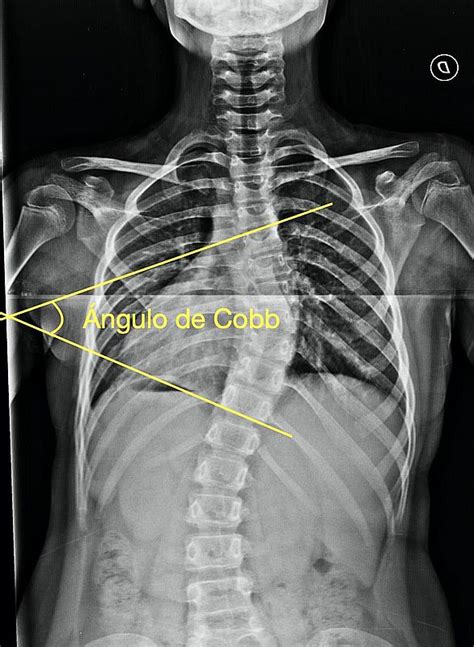 Ángulo de Cobb y Escoliosis Ortopedia Plantia Donostia San Sebastián