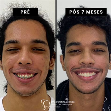 Cirurgia Ortogn Tica Especialista Bucomaxilofacial Dra Carolina
