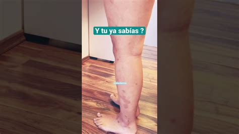 Descubre Las Causas De Las Manchas Rojas En Las Piernas Sin Picor Ni