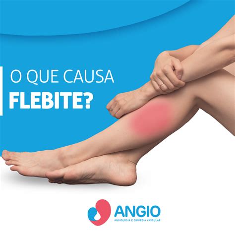 O Que Causa Flebite Angio Angiologia E Cirurgia Vascular