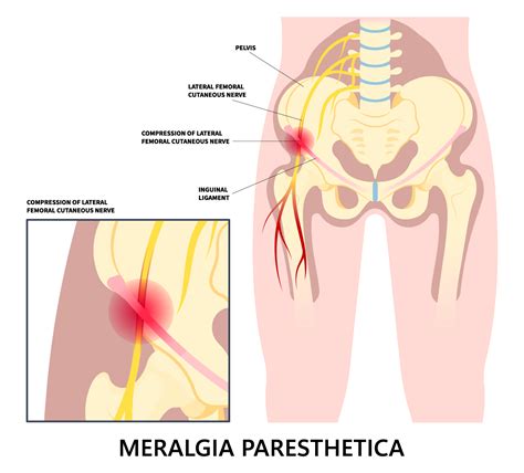 Lateral Thigh Numbness Meralgia Paresthetica Orthopedic Case Of The