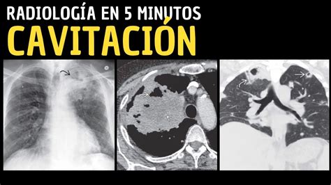 Radiolog A En Minutos Signos Radiol Gicos Pulmonares Cavitaci N