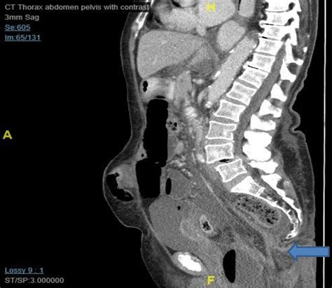 Perineal Hernia In Women