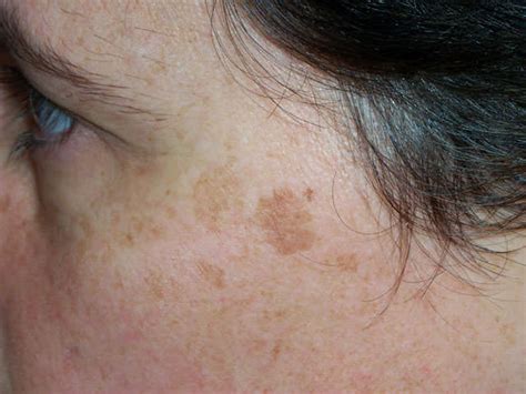 Raised Brown Spots On Body
