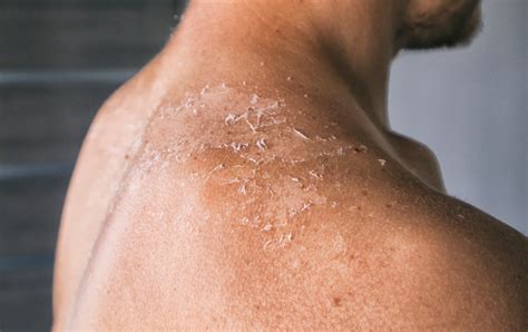 What Is Fungal Acne Pityrosporum Folliculitis Causes And Treatment