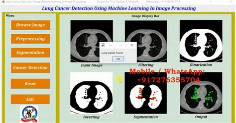 lung cancer detection using machine learning technique matlab project source code ~ engineering