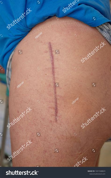 Devastated Hip Joint Images Stock Photos Vectors Shutterstock