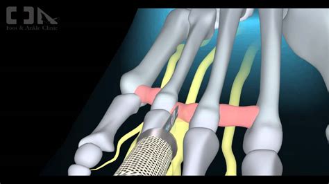 Minimally Invasive Morton S Neuroma Surgery Youtube