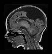 MRI Of The Neonatal Brain Mary A Rutherford