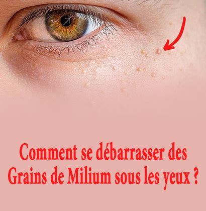 Comment se débarrasser des Grains de Milium sous les yeux