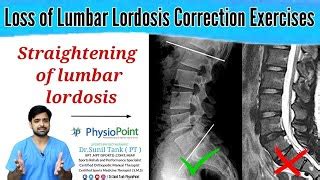 Loss Of Lumbar Lordosis Exercises