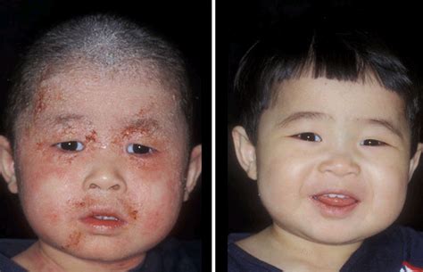 Atopic Dermatitis Picture Hardin Md Super Site Sample