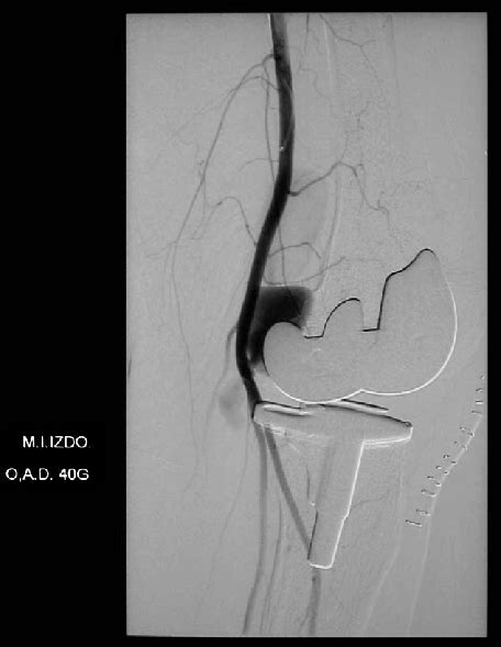 Digital Subtraction Arteriogram Showing A Pseudoaneurysm Arising From