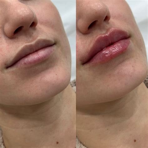Diseño de labios con ácido hialurónico Lemont Clinic