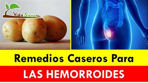 Remedios Naturales Que Sirven Para Curar Las Hemorroides Vida Sana