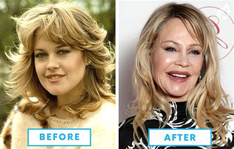 Plastic Surgery Gone Wrong Celebrities Before And After