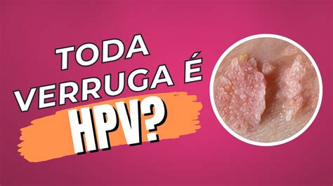 Verrugas Genitais Como Saber se é HPV