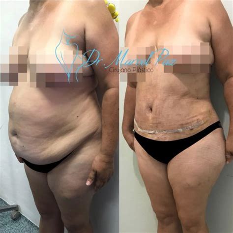 Abdominoplastia Antes y Después Dr Marcel Paz Cirugía Plástica