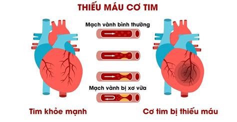 Nhồi Máu Cơ Tim Không ST Chênh Nguyên Nhân Triệu Chứng và Điều Trị