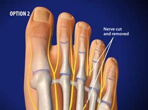 Excision Of Morton S Neuromas In Plano Frisco Mckinney And Allen