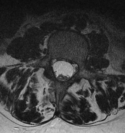 Tethered Cord With Filum Terminale Lipoma And Sacrococcygeal Dysgenesis