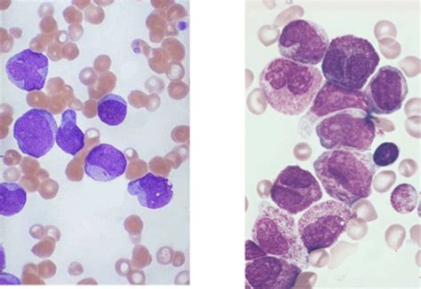 Wbc Morphology Leukemia Flashcards Quizlet
